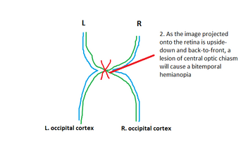 Homonymous Hemianopia Bitemporal Hemianopia | Barts Wiki | Fandom