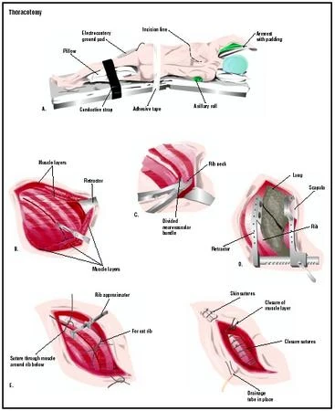 Thoracotomy | ER wiki | FANDOM powered by Wikia