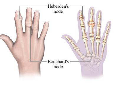 Osteoarthritis | Butler Pharmacy Wiki | FANDOM powered by Wikia