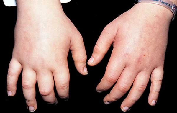 Fisiopatologia do Edema | Infomedica Wiki | FANDOM powered by Wikia