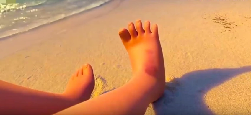 Image - Moana-foot-bruise.png | Moana Wikia | FANDOM powered by Wikia