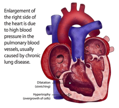 Cor Pulmonale | My Medical Handbook Wiki | Fandom