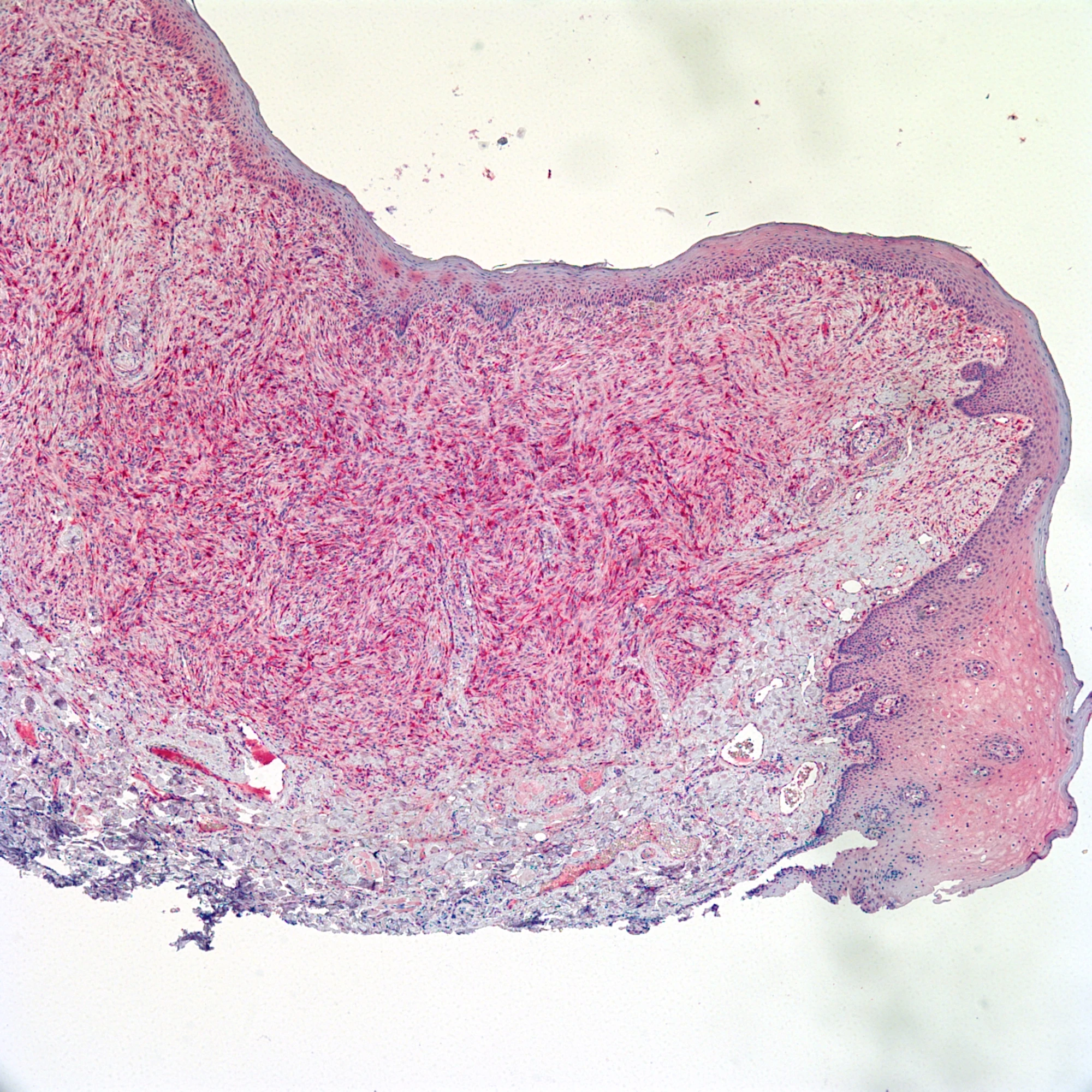 Factor XIIIa (Factor 13a) | Pathology Resident Wiki | Fandom
