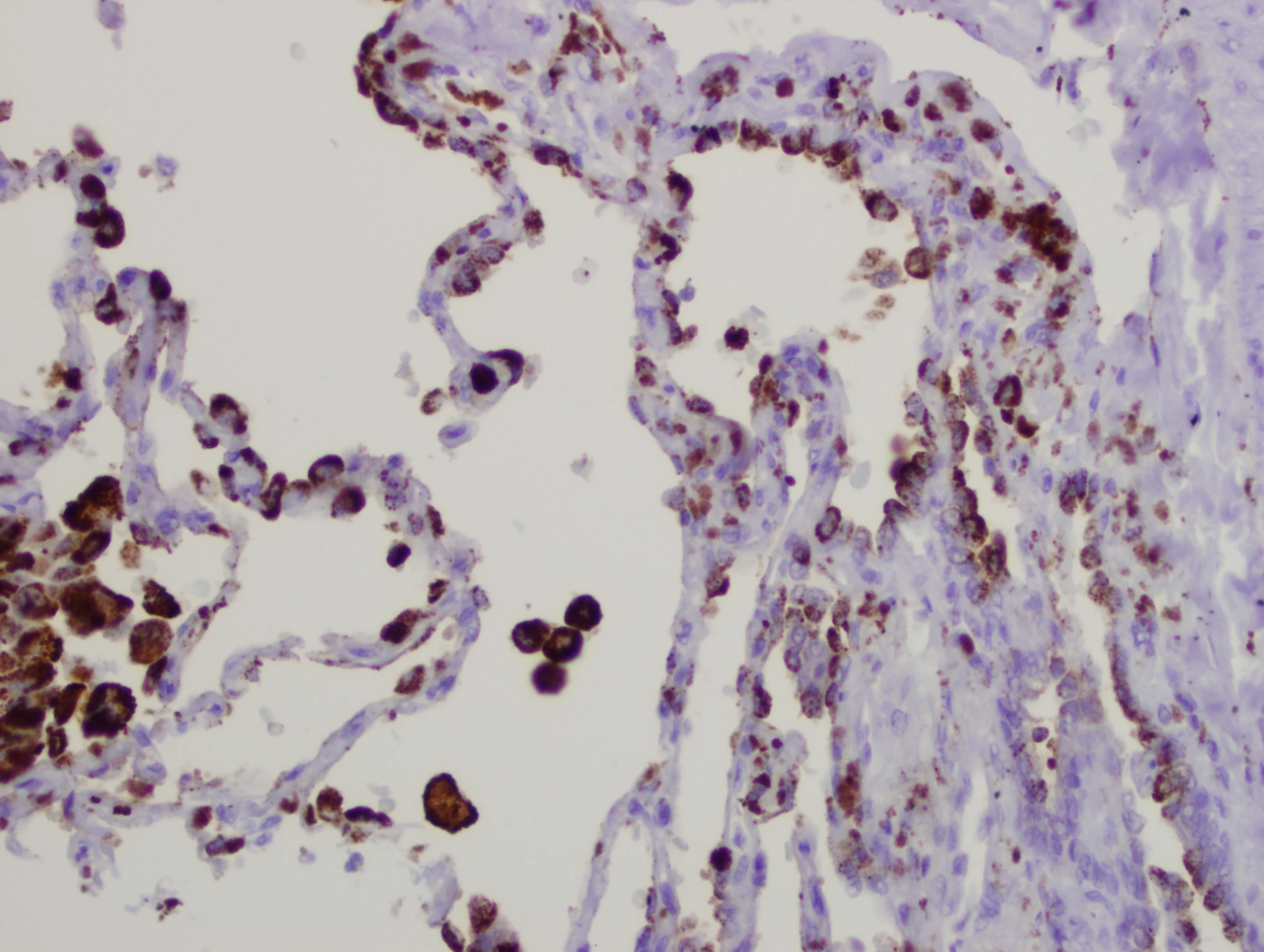 Napsin A | Pathology Resident Wiki | Fandom