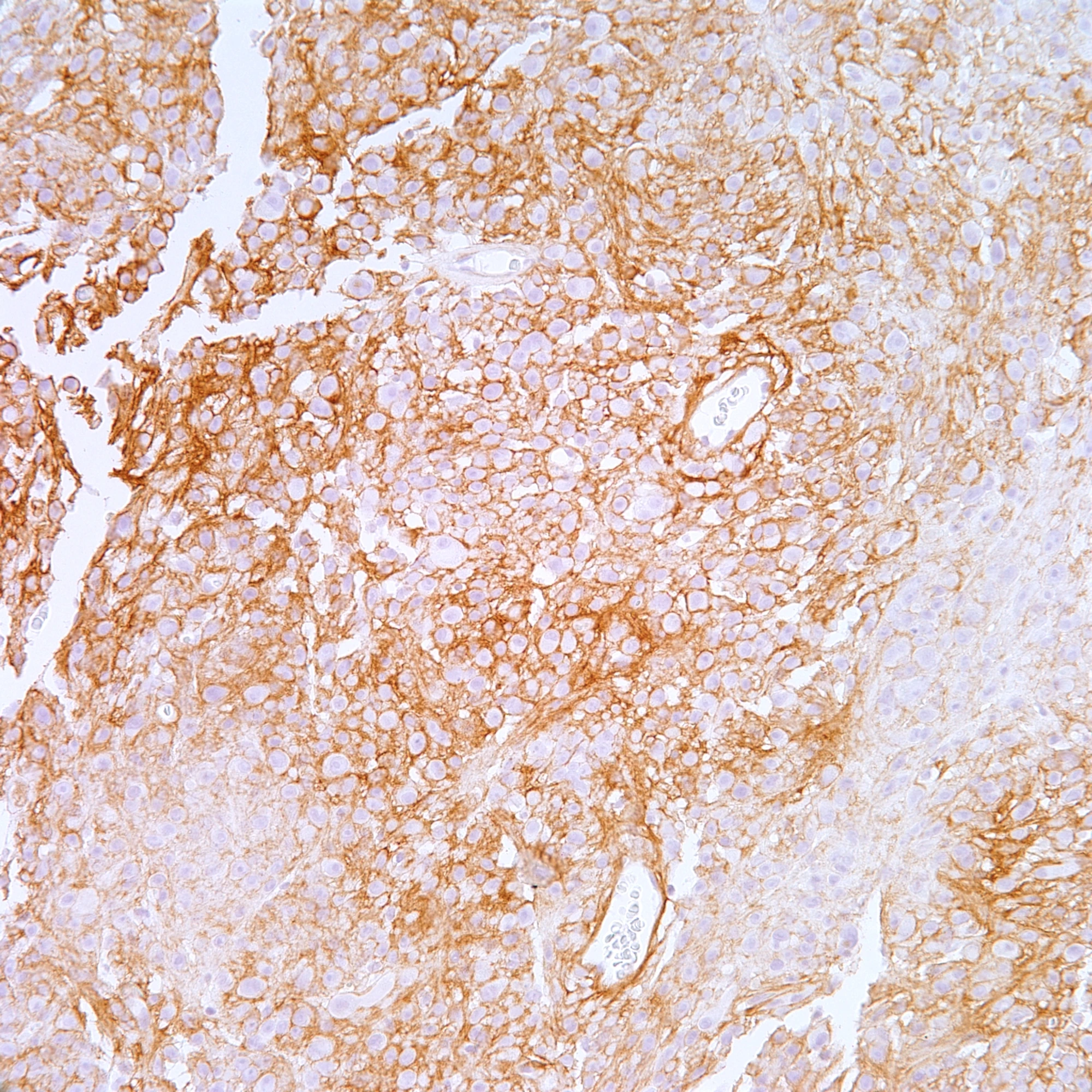 Type IV Collagen | Pathology Resident Wiki | Fandom