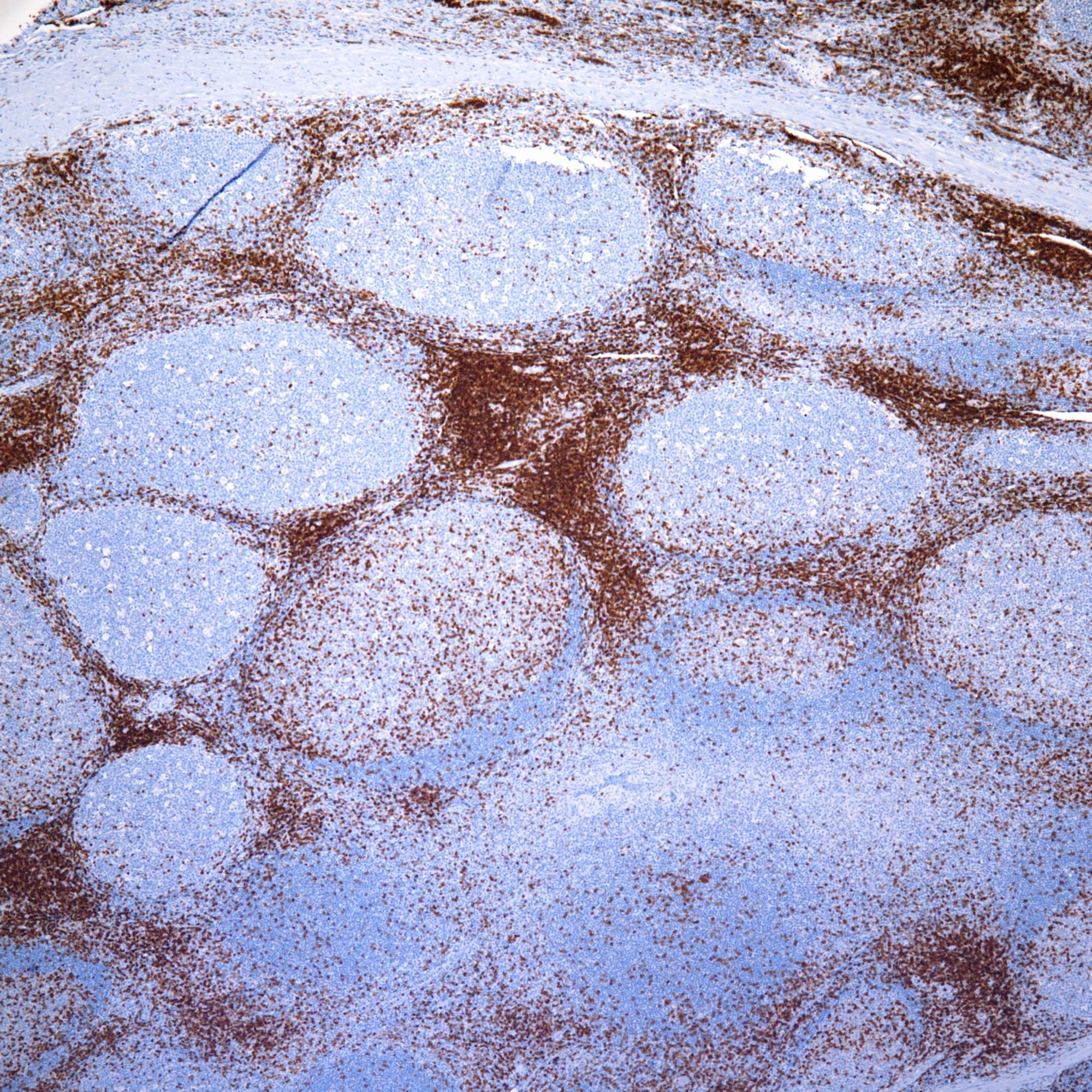 Image - CD3.tonsil.2.jpg | Pathology Resident Wiki | FANDOM powered by ...