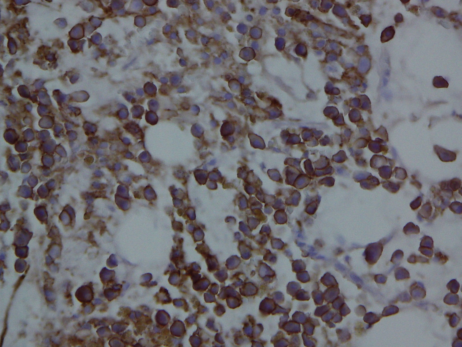 CD56 | Pathology Resident Wiki | Fandom