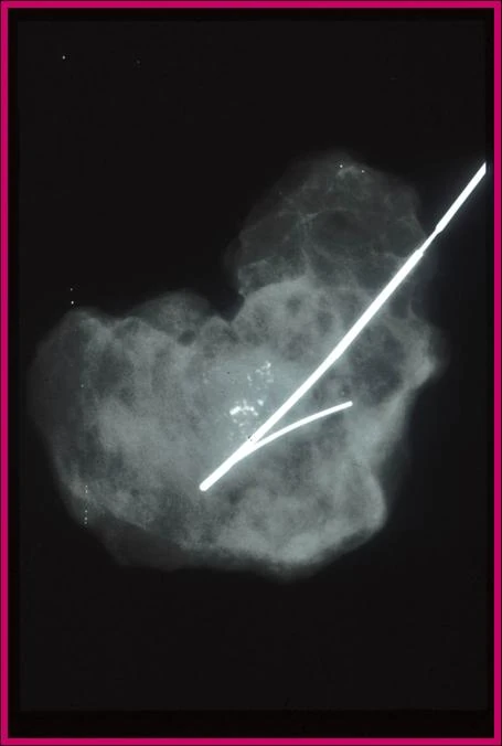 Partial mastectomy | Pathology Resident Wiki | Fandom