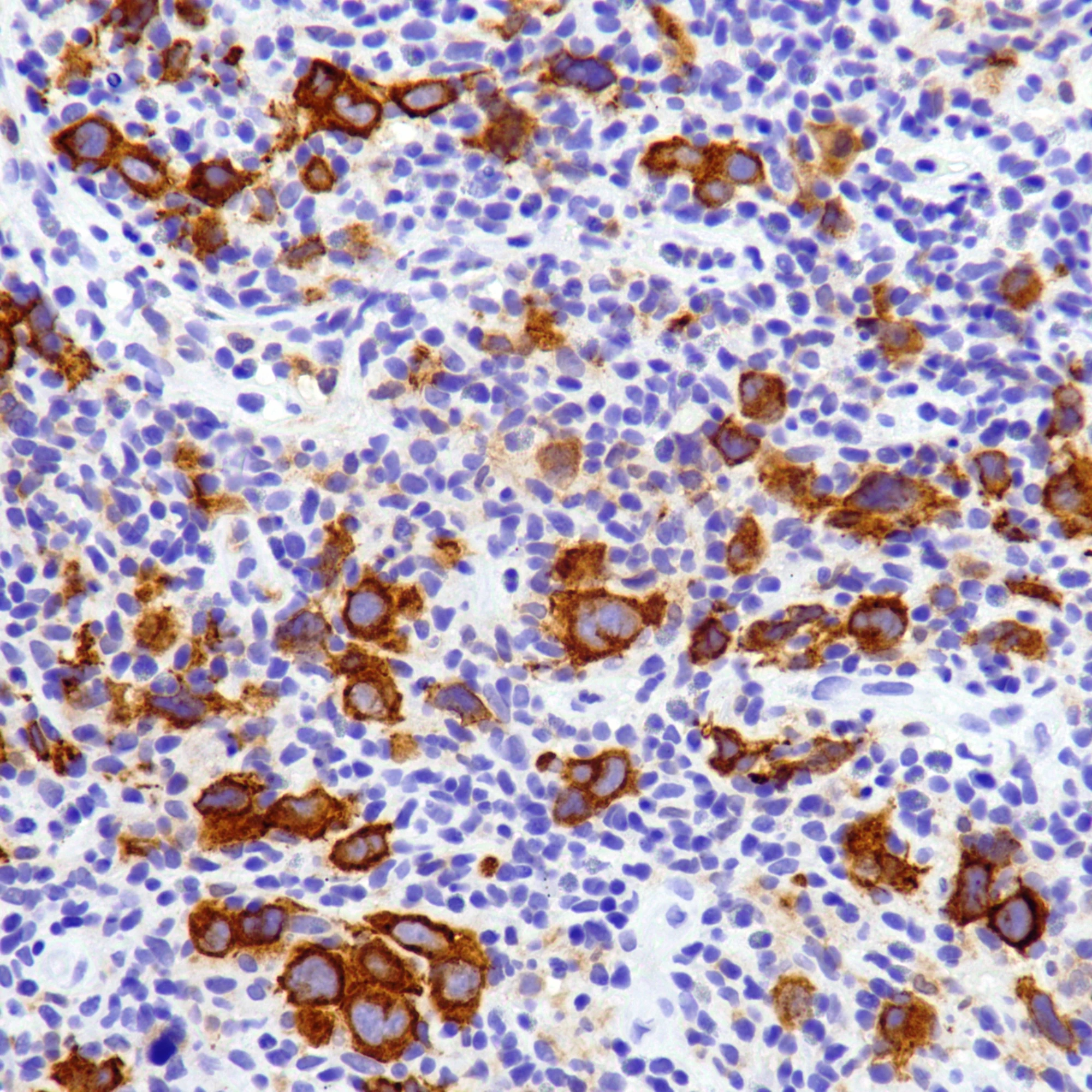 CD30 | Pathology Resident Wiki | Fandom