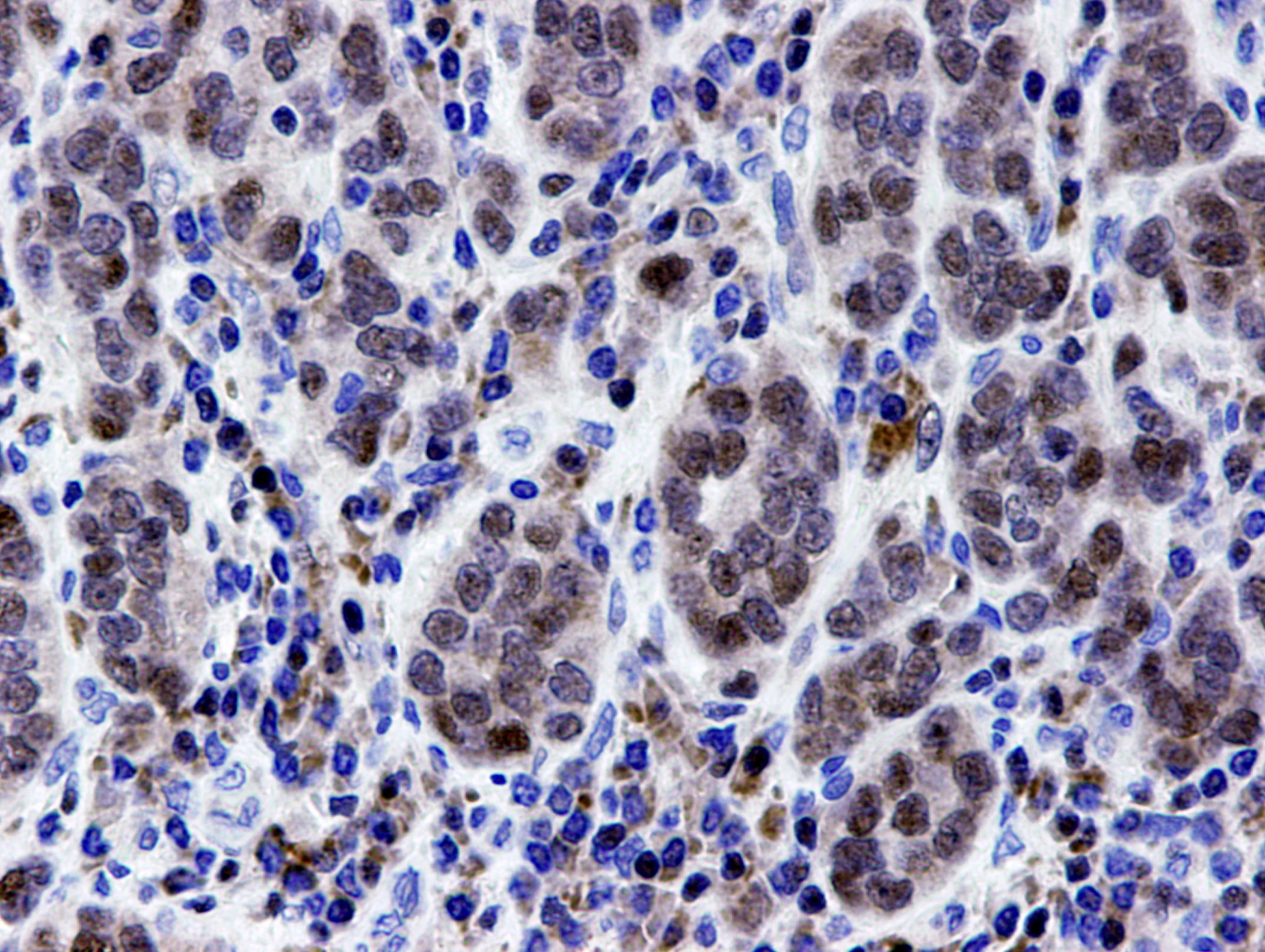 SOX10 | Pathology Resident Wiki | Fandom