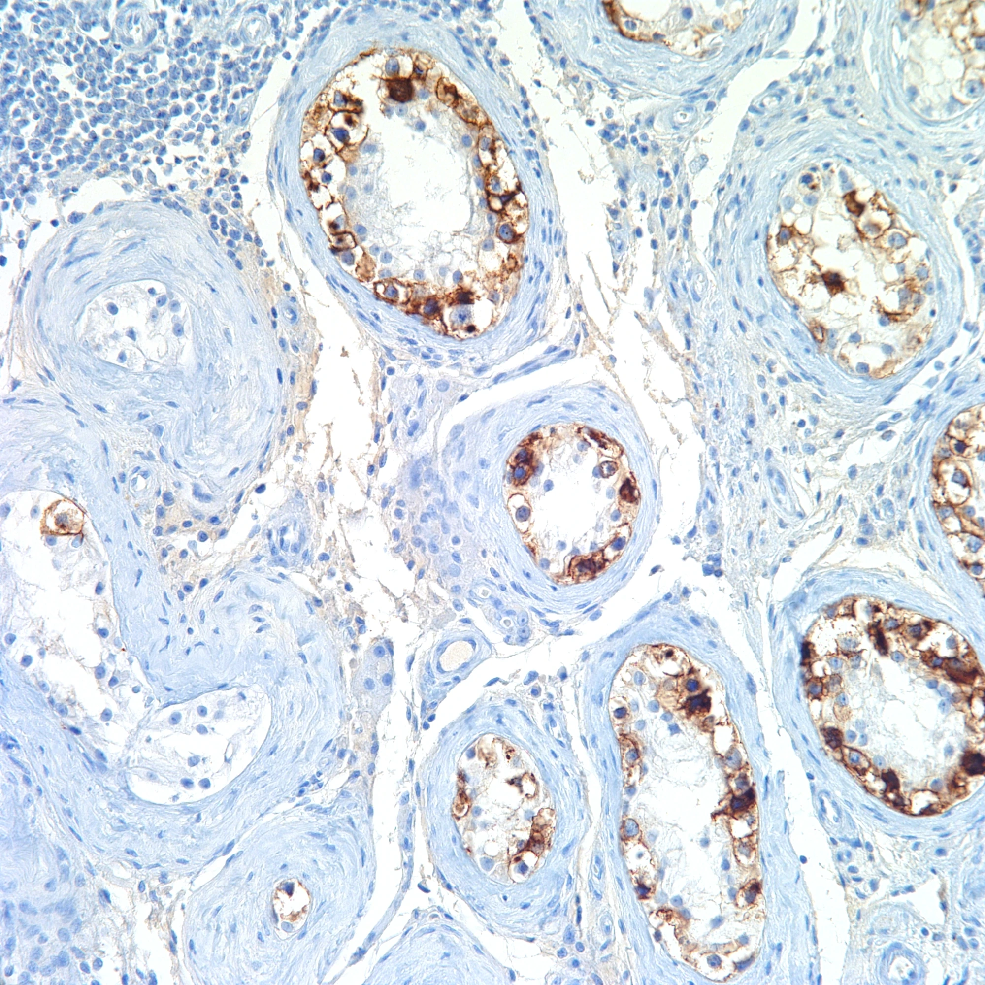 Placental Alkaline Phosphatase (PLAP) | Pathology Resident Wiki | Fandom