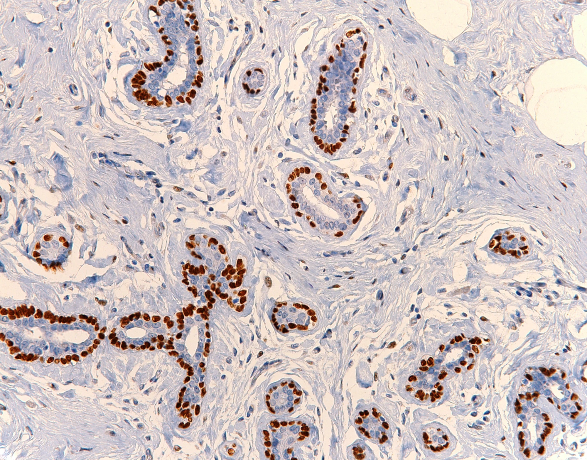 Image - P63.breast.200x.jpg | Pathology Resident Wiki | FANDOM powered ...