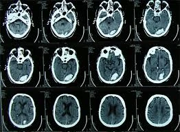 Tomografía axial computarizada | Tecnicas de Neuroimagen Wiki | Fandom