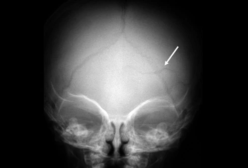 Skull Fracture | Trauma Care Test Wiki | Fandom