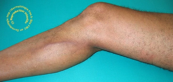 Phlébite superficielle | Wikige Wiki | FANDOM powered by Wikia